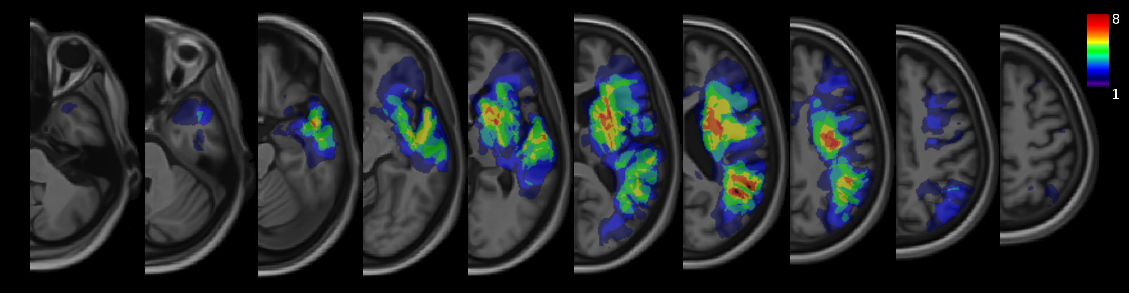 Dynamics of language recovery in post-stroke aphasia: A longitudinal ...