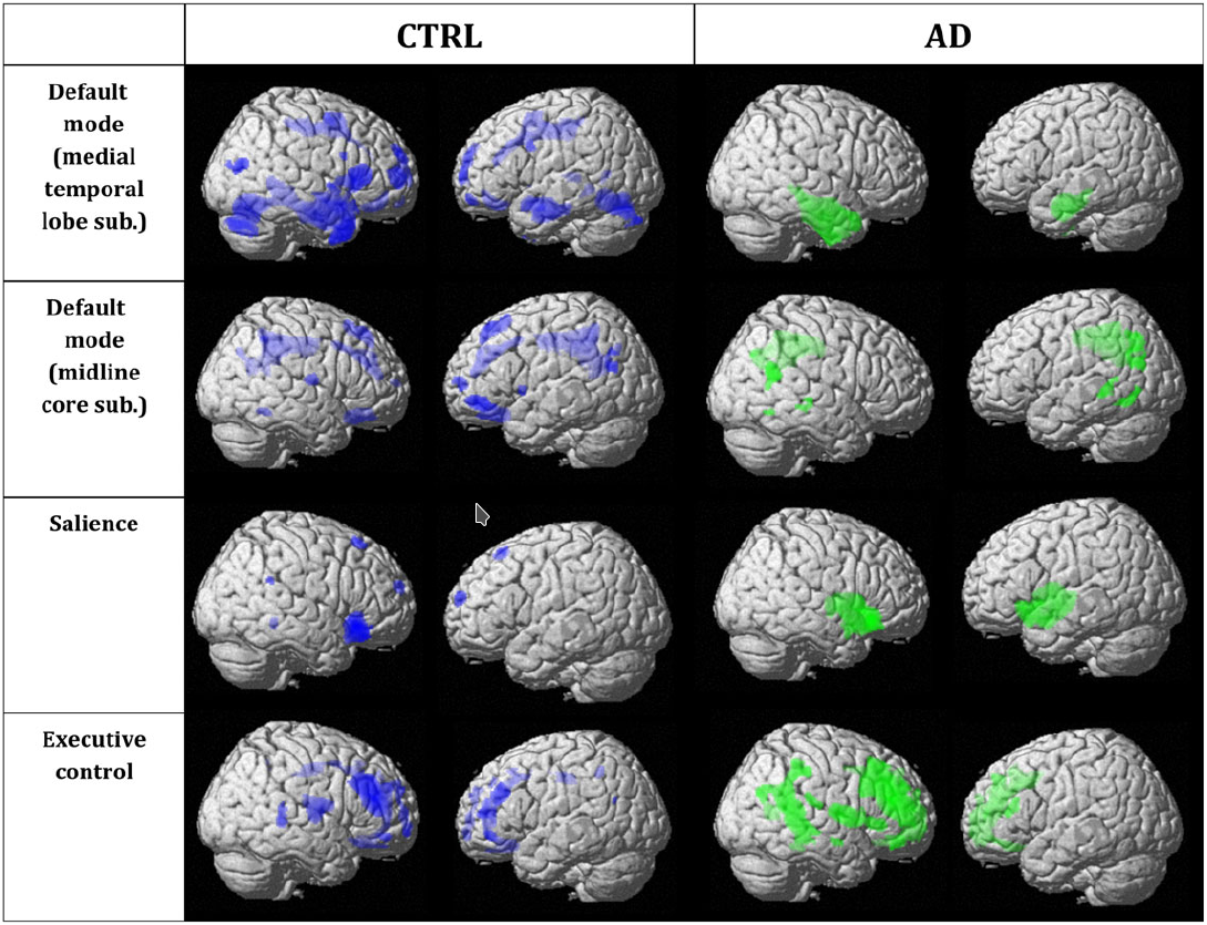 Altered Gray Matter Structural Covariance Networks in Early Stages of Alzheimer's Disease ...